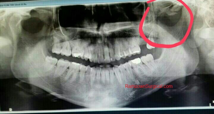 الام مفصل الفك – ramzownsurgical